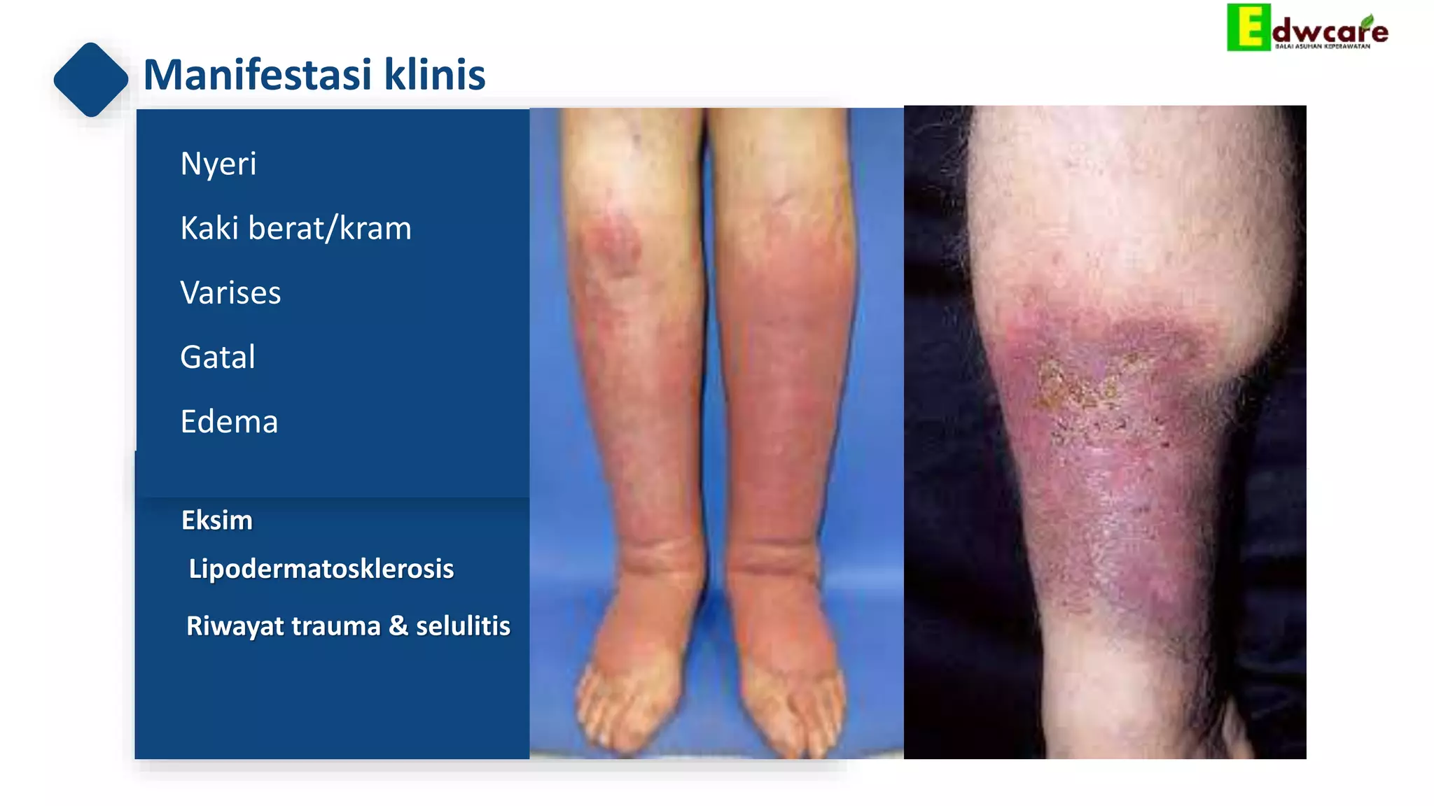 2. Ns Edy_venous and artery ulcer).pptx