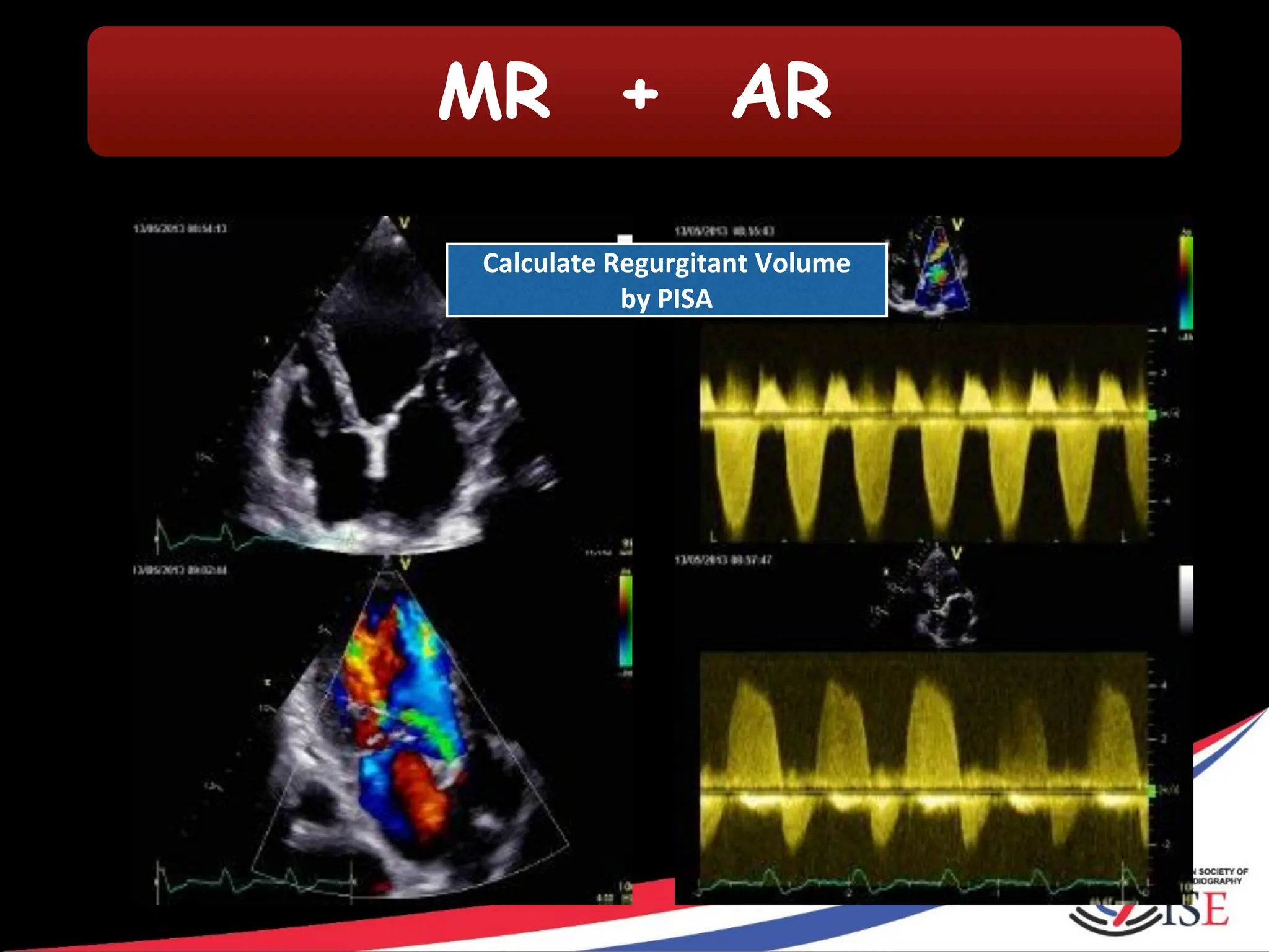 2. Evaluation of multiple valve disease.pdf