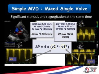 2. Evaluation of multiple valve disease.pdf