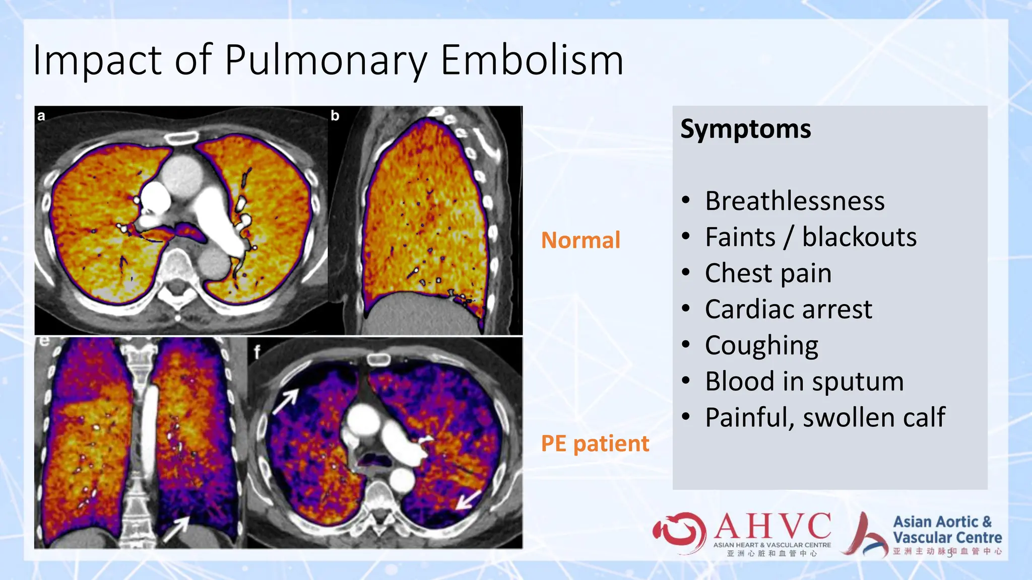 Pulmonary Embolism No. 1 Cause of Preventable Hospital Death Worldwide ...