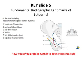 Mock Clinical Examination Long case Acetabulum frx.pptx | Death, Injury ...