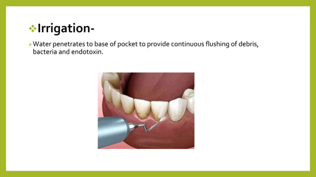 Sonic and ultrasonic instruments in periodontology.pptx | Oral care ...