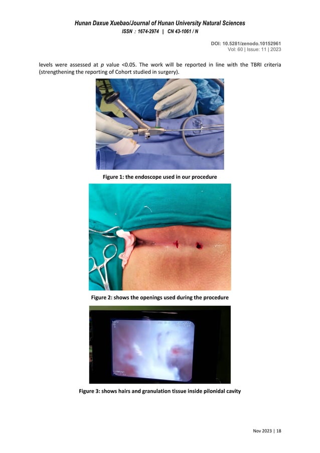 ENDOSCOPIC TREATMENT OF PILONIDAL SINUS IN EGYPTIAN PATIENTS | PDF ...