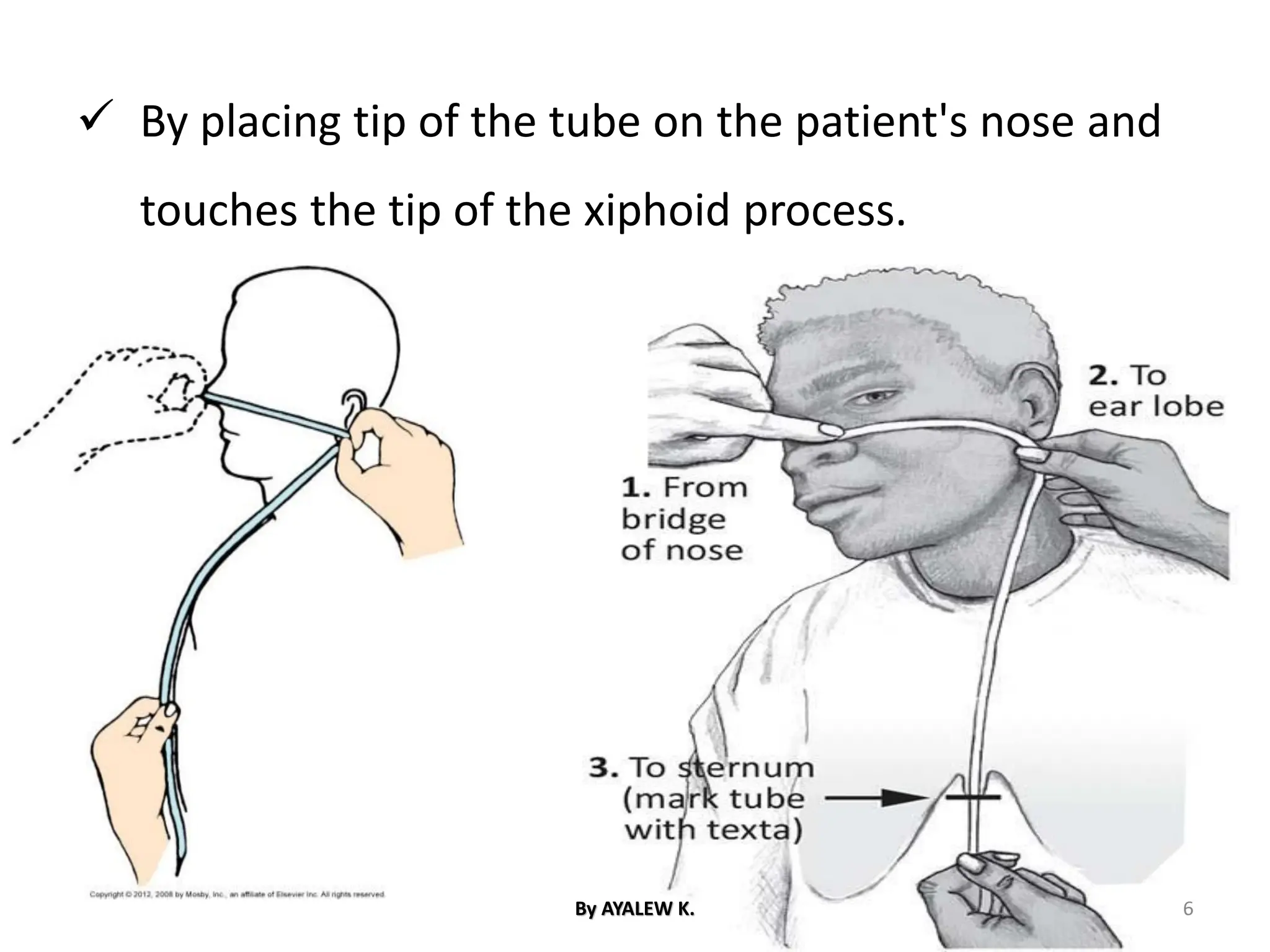 NASOGASTRIC TUBE INSERTION.pdf