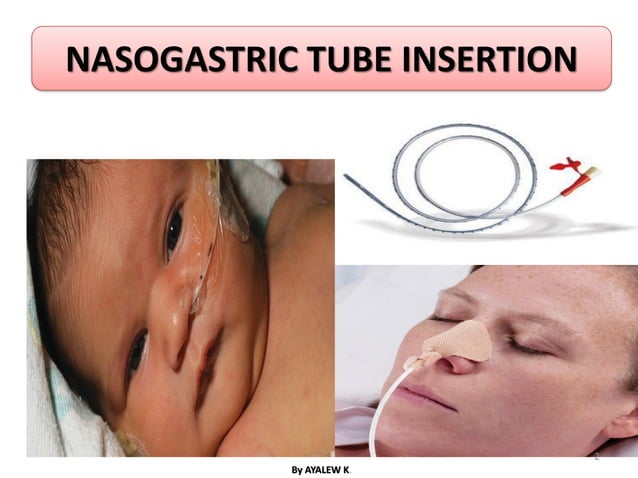NASOGASTRIC TUBE INSERTION.pdf | First Aid | Injuries