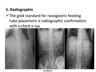 NASOGASTRIC TUBE INSERTION.pdf