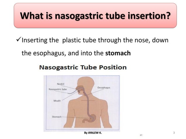 NASOGASTRIC TUBE INSERTION.pdf | First Aid | Injuries