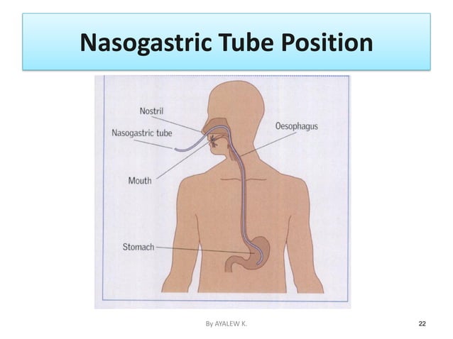 NASOGASTRIC TUBE INSERTION.pdf | First Aid | Injuries