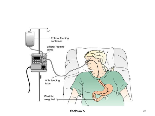 NASOGASTRIC TUBE INSERTION.pdf