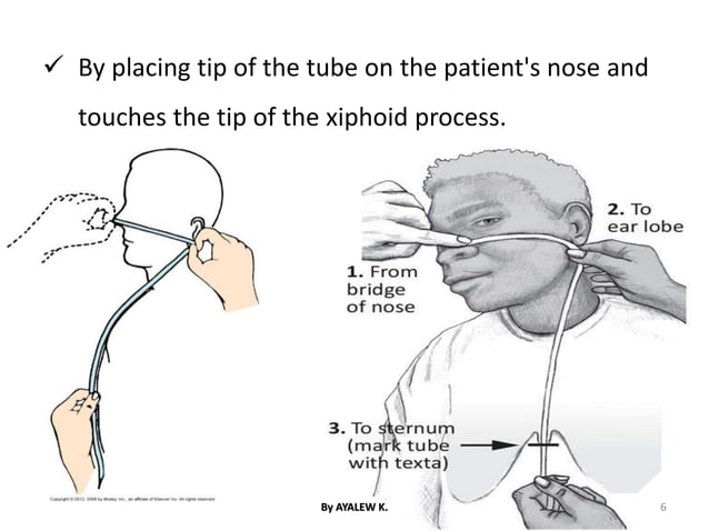 NASOGASTRIC TUBE INSERTION.pdf | First Aid | Injuries