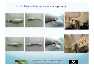 2.3_Tiempos_de_la_exodoncia_con_forceps_y_con_elevadores.pdf