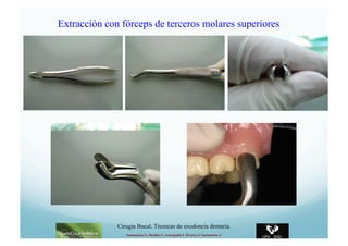 2.3_Tiempos_de_la_exodoncia_con_forceps_y_con_elevadores.pdf