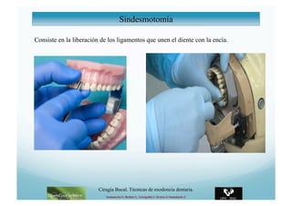 2.3_Tiempos_de_la_exodoncia_con_forceps_y_con_elevadores.pdf