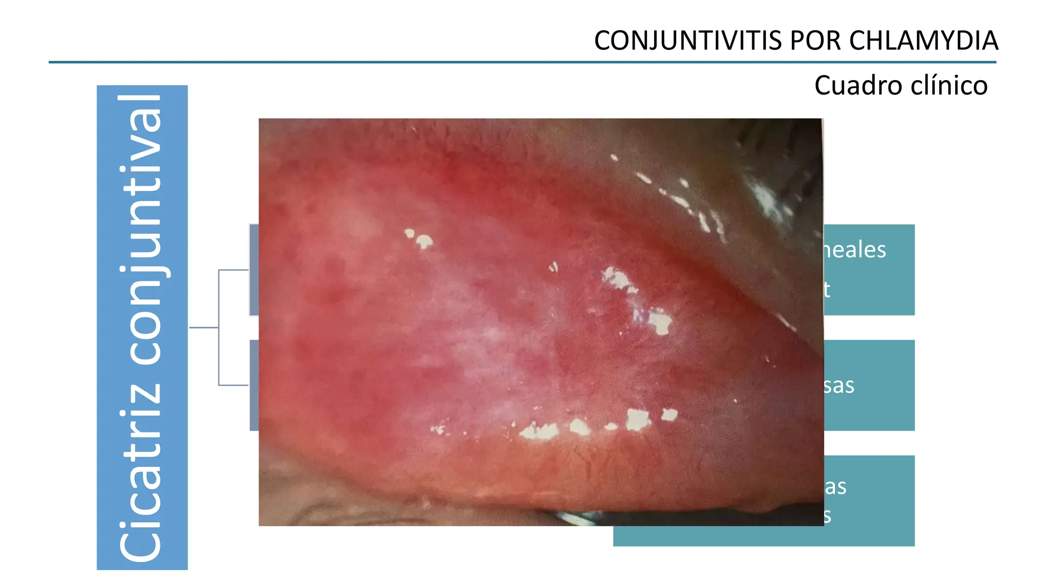 2.- CONJUNTIVITIS CLAMIDIA.pptx--.......... | PPTX