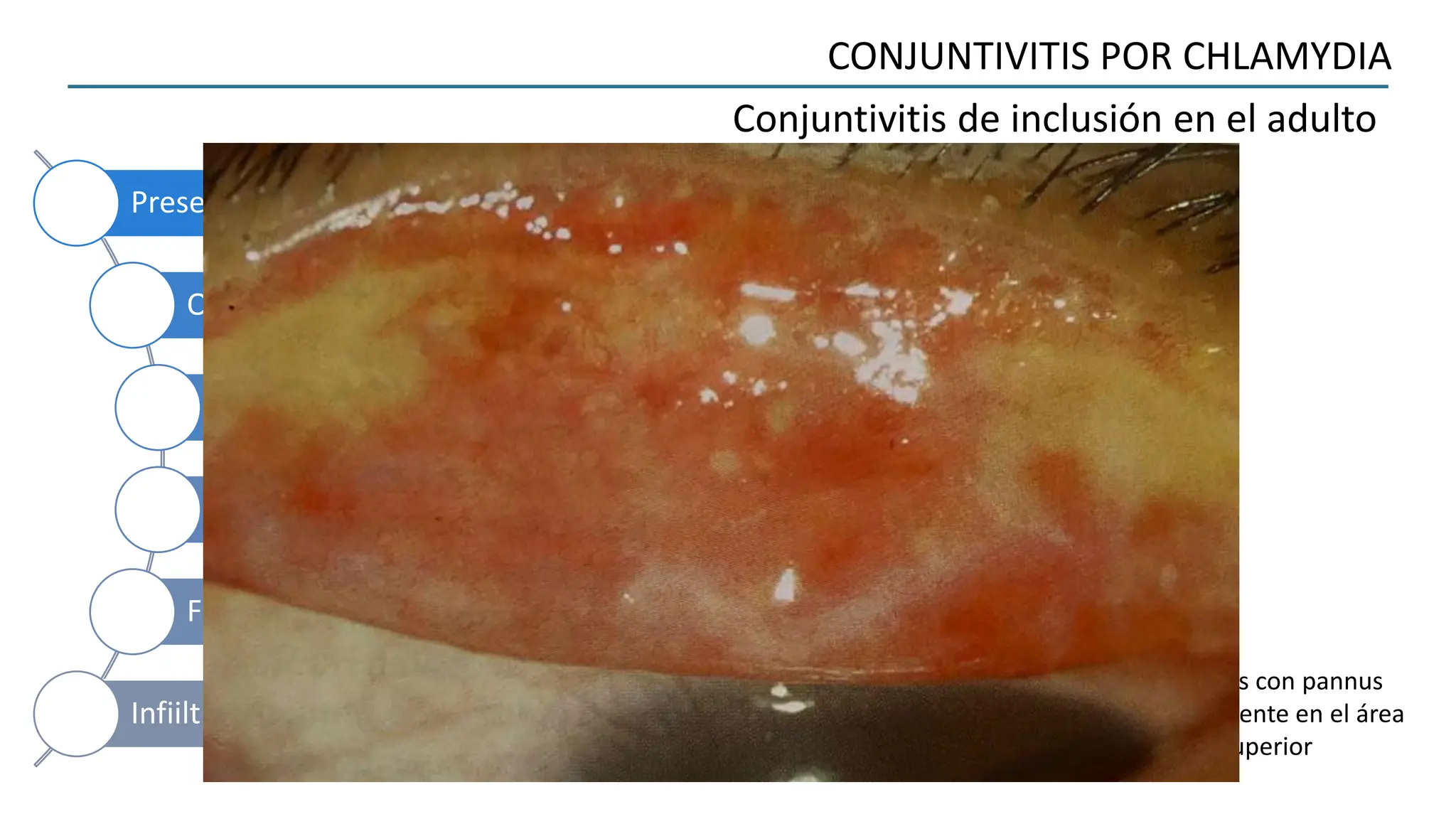 2.- CONJUNTIVITIS CLAMIDIA.pptx--.......... | PPTX