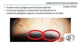 2.- CONJUNTIVITIS CLAMIDIA.pptx--.......... | PPTX