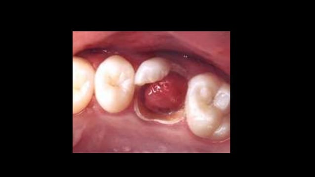 2.PATOLOGIA PULPAR Y PERIAPICALppt.pptx. | PPT