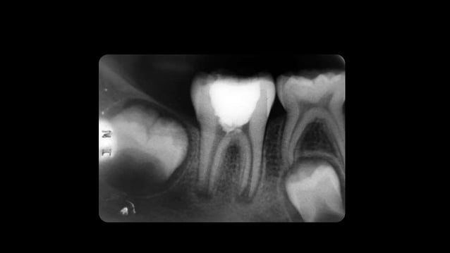 2.PATOLOGIA PULPAR Y PERIAPICALppt.pptx. | PPT