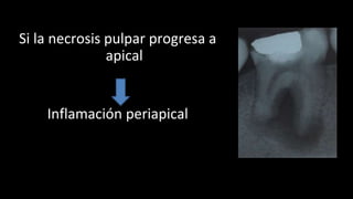 2.PATOLOGIA PULPAR Y PERIAPICALppt.pptx. | PPTX
