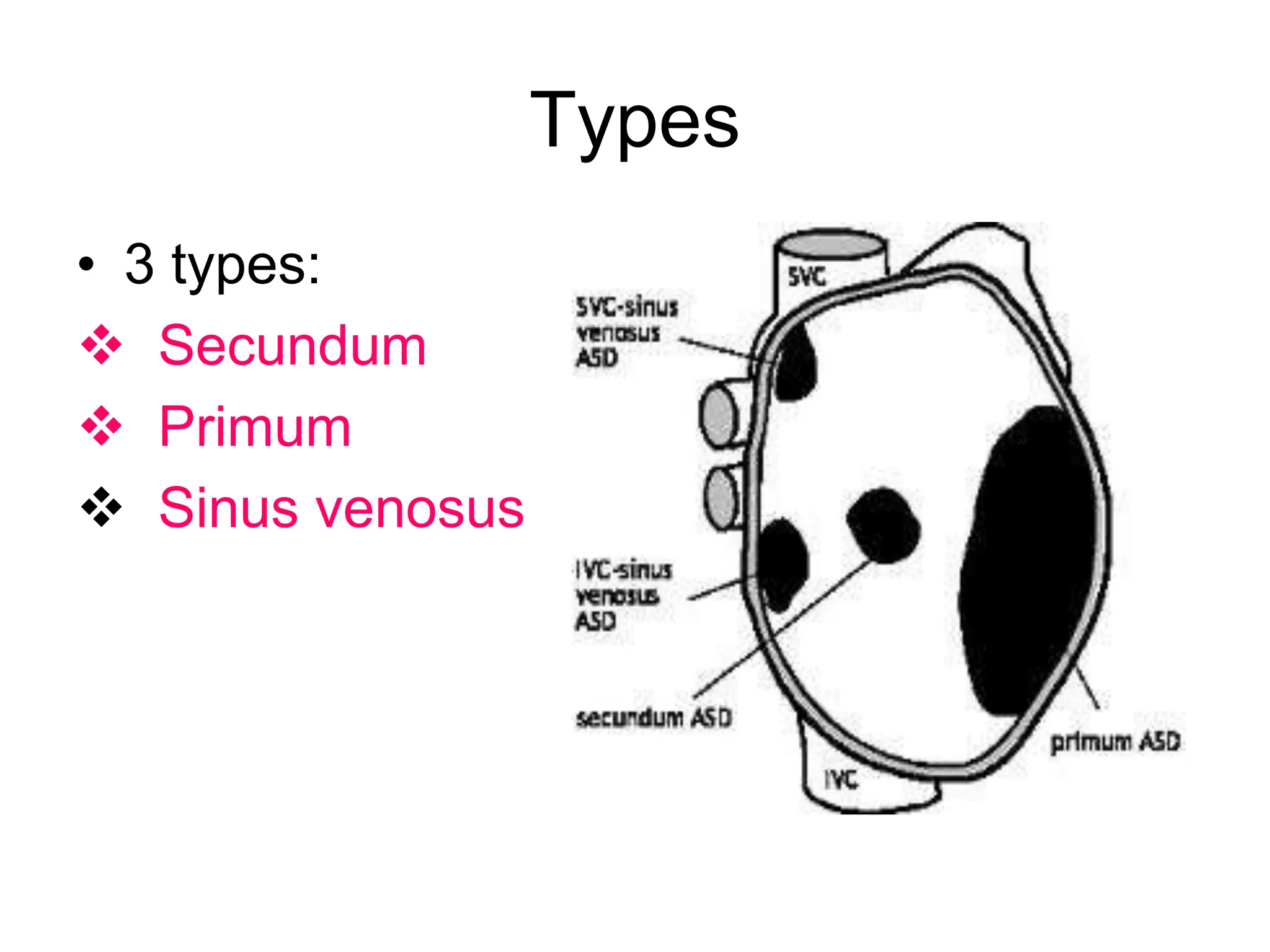 2. Atrial Septal Defect - M.Rafi HAMIDI.ppt | Heart and Cardiovascular ...