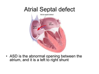 2. Atrial Septal Defect - M.Rafi HAMIDI.ppt | Heart and Cardiovascular ...