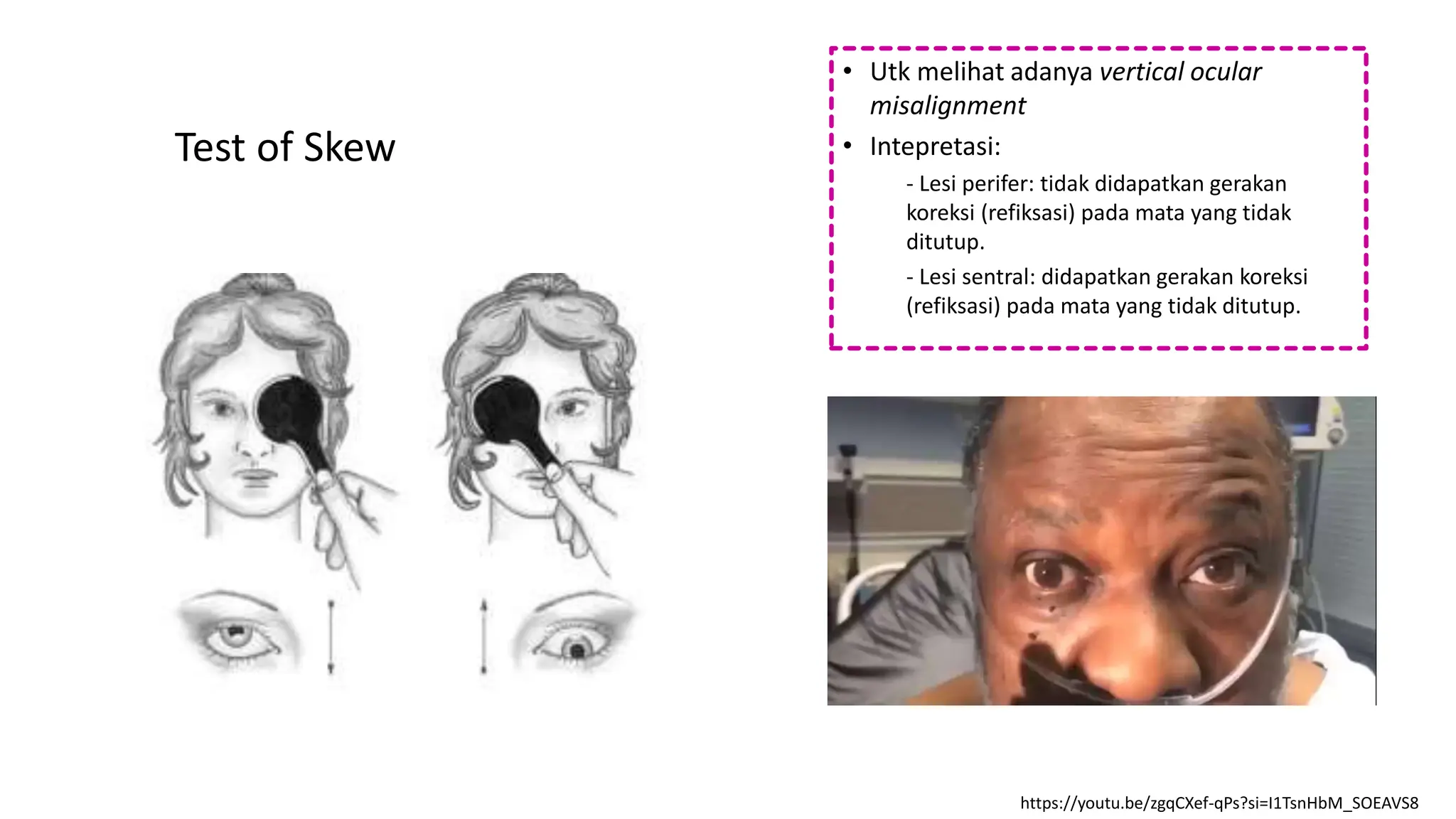MATERI-KULIAH-PPT-GANGGUAN-VESTIBULAR.pptx