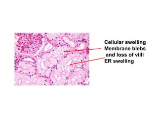 2.CELLULAR DEGENERATION AND....... INFILTRATION-1.ppt