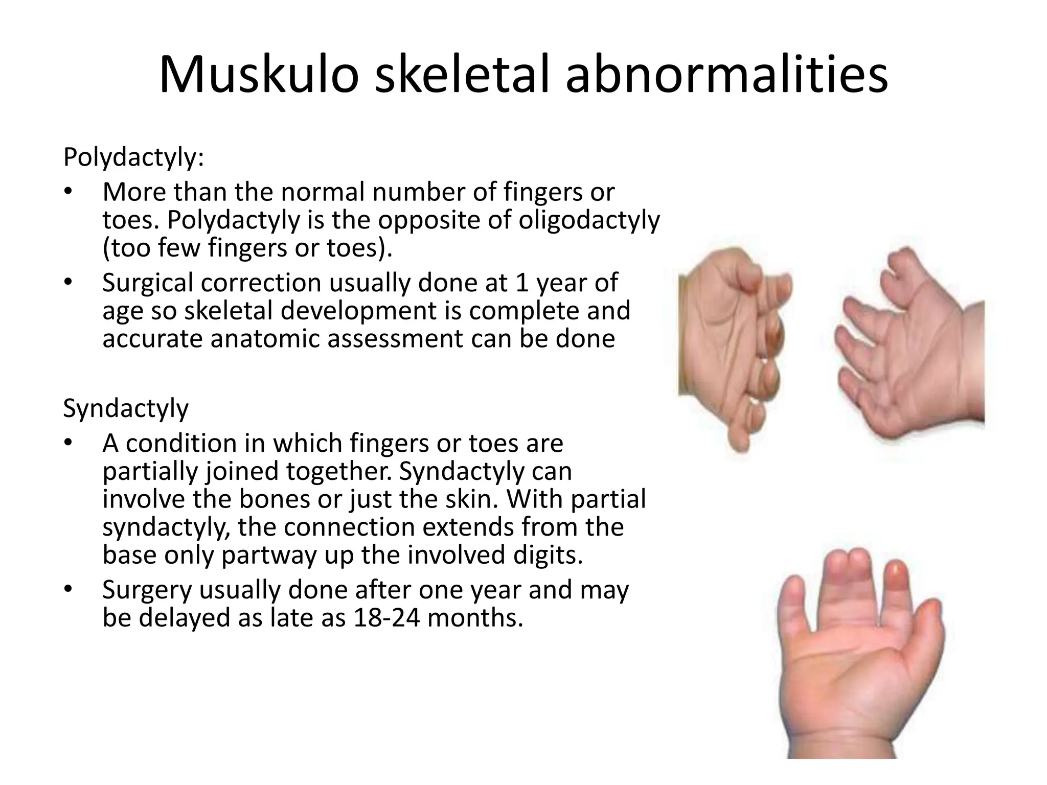 PPT ON Congenital anomalies.pptx