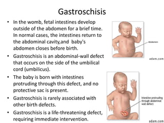 PPT ON Congenital anomalies.pptx