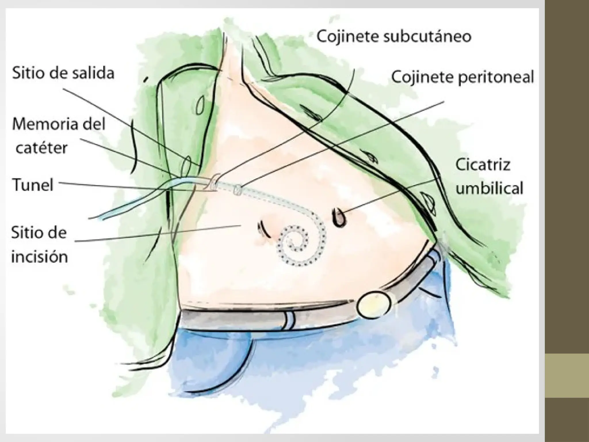 técnica de colocación de cateter Tenckhoff | PPTX