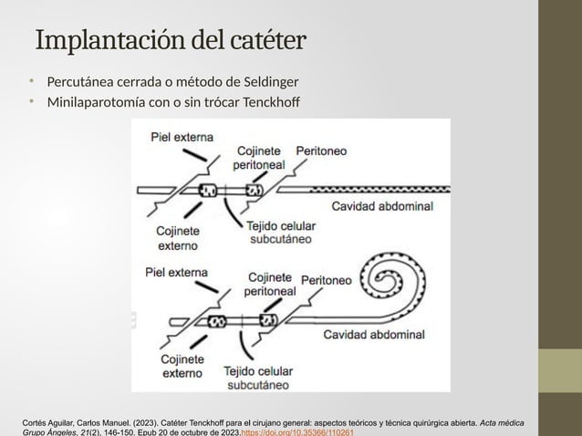 técnica de colocación de cateter Tenckhoff | PPTX