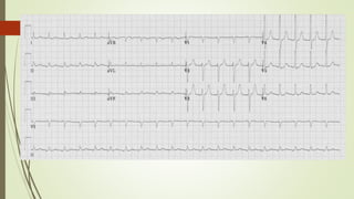 HEART RHYTHYMS and ecg and heart rhythyms and all | PPT