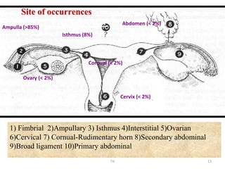 2.2.Ectopic pregnancy.pathophysiology Pharynx | PPT