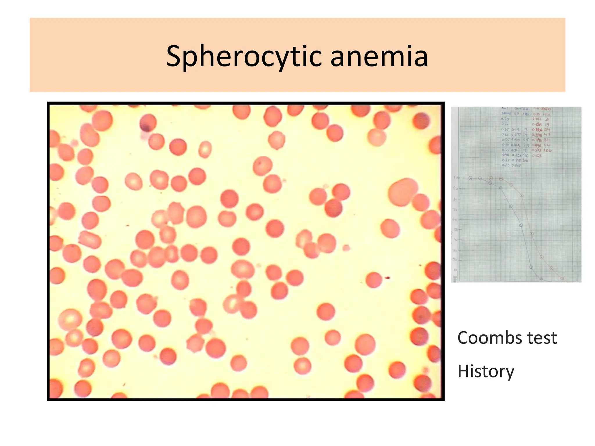 Peripheral blood smeared examination test | PDF
