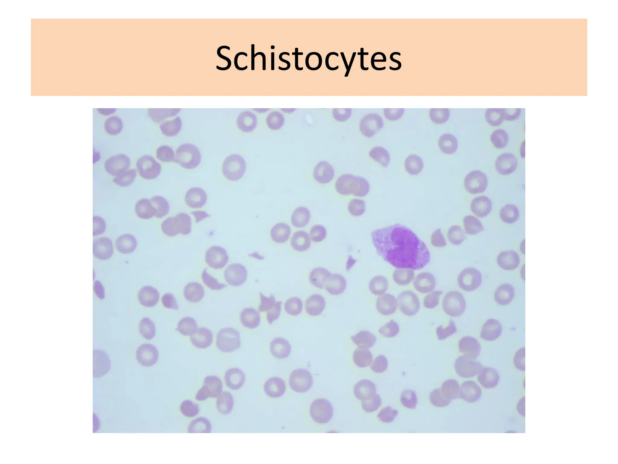 Peripheral blood smeared examination test | PDF