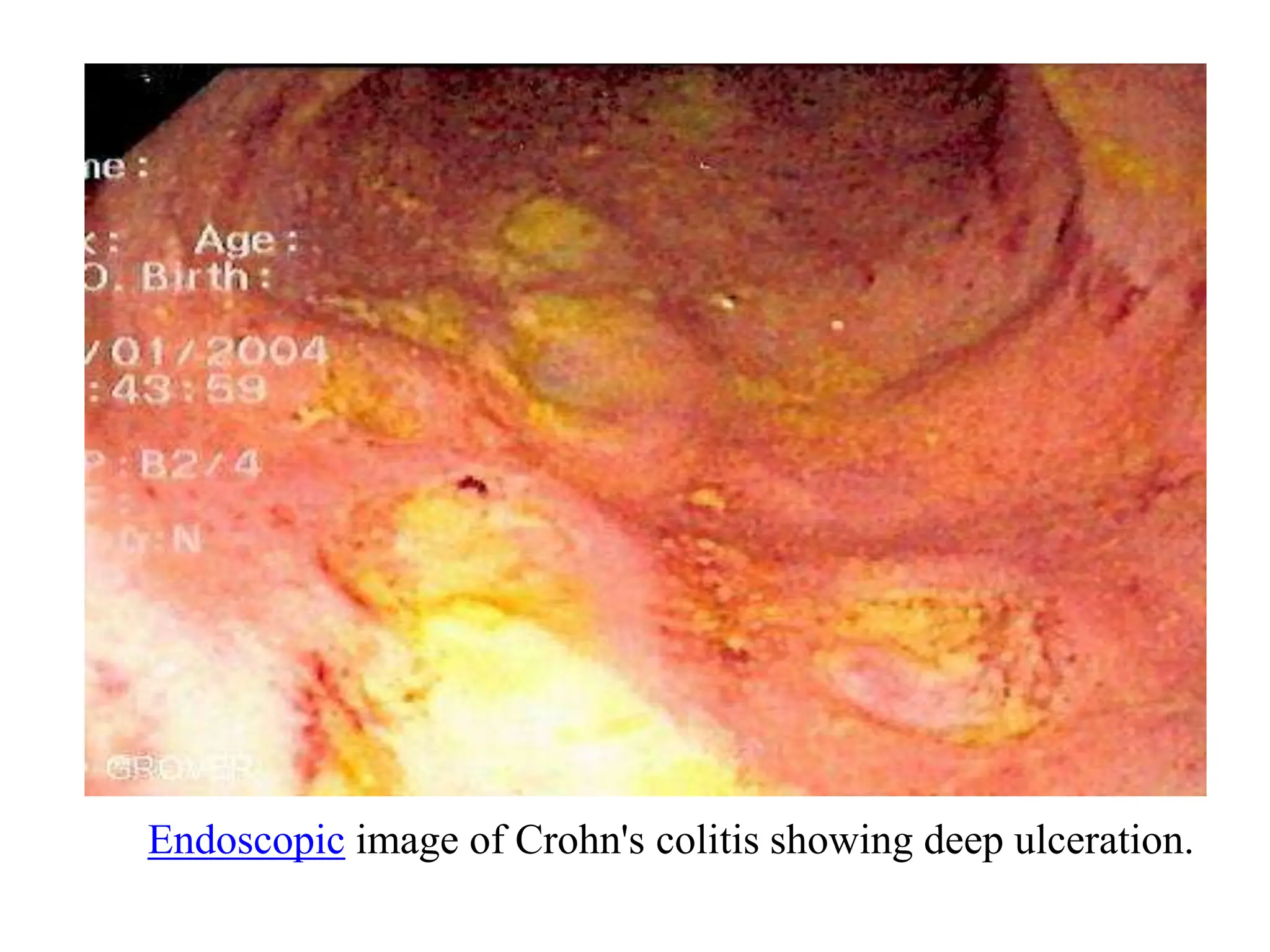 2.Inflammatory bowel disease type,diagnosis and treatment | PPTX