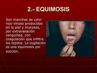 2. LESIONOLOGIA ORAL FORENSE. odontologiapdf | PDF