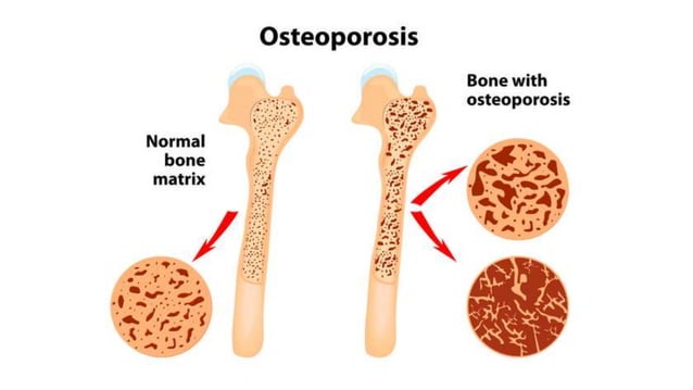 Diseases of bones and joint(Pathophysiology of Osteoarthritis) | PPTX