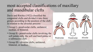 Maxillomandibular defects and treatment.pptx