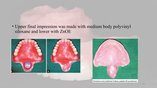 Maxillomandibular defects and treatment.pptx