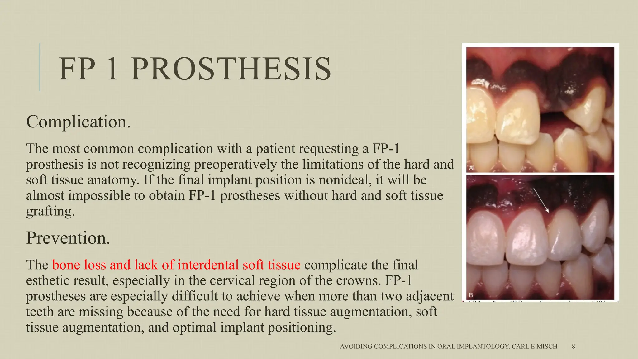Complications and their management in implantology | PPTX