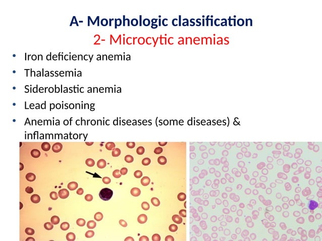 2.anemia classification system class.pptx