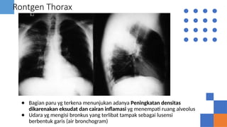 Materi Bimbingan Pneumonia Bacterial Radiologi | PPTX