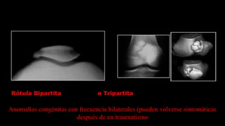 FRACTURA DE ROTULA TRATAMIENTO CONSERVADOR Y QUIRURGICO | PPTX
