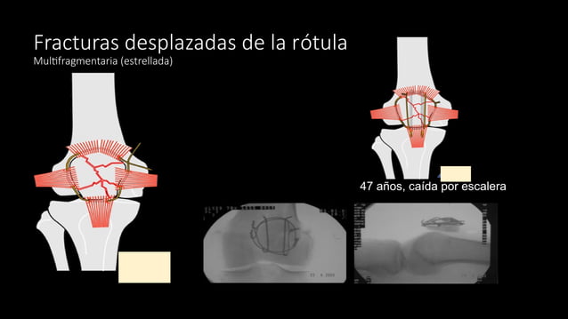 FRACTURA DE ROTULA TRATAMIENTO CONSERVADOR Y QUIRURGICO | PPTX