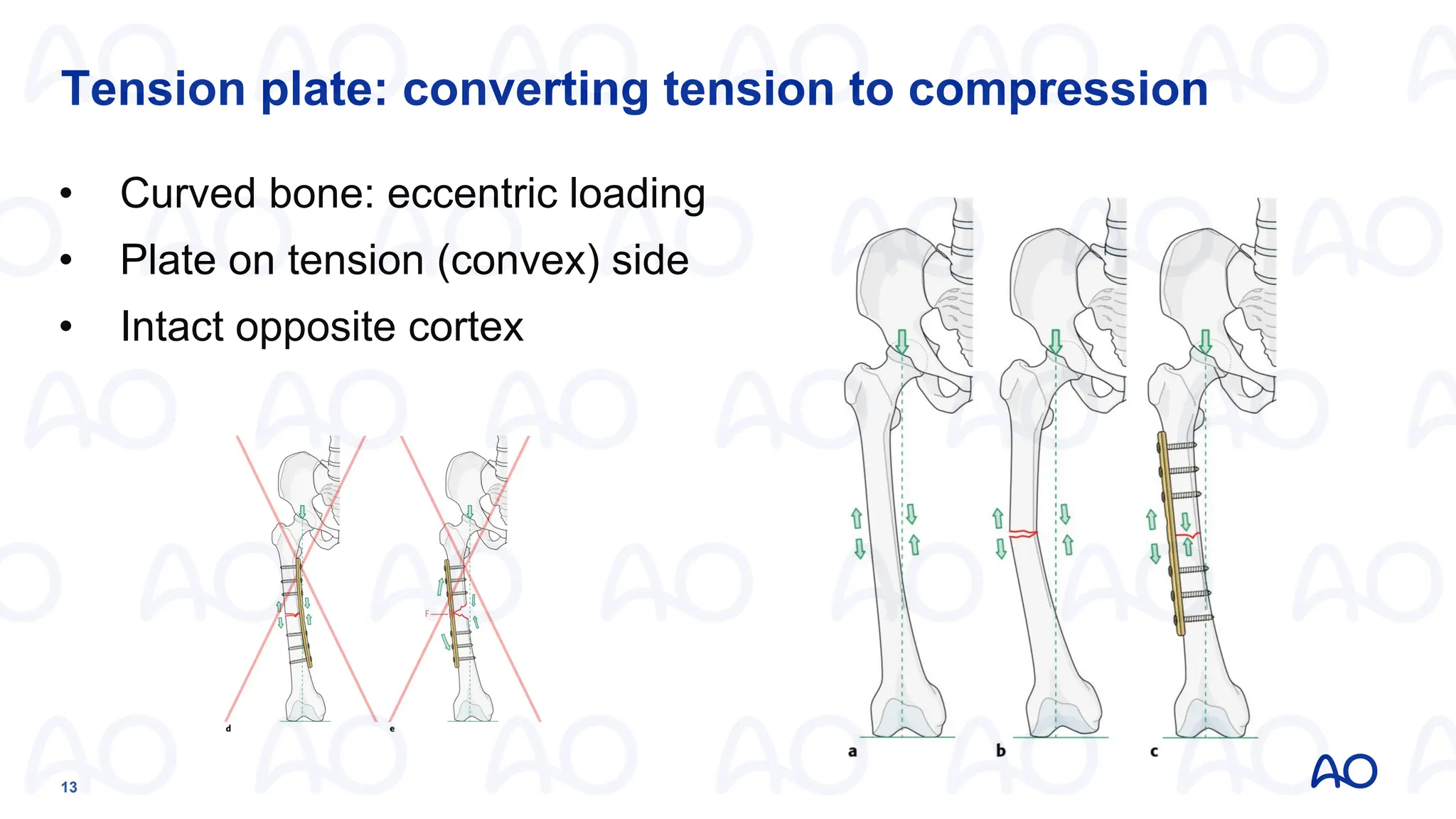 plates in fracture fixation on orthopedic | PDF