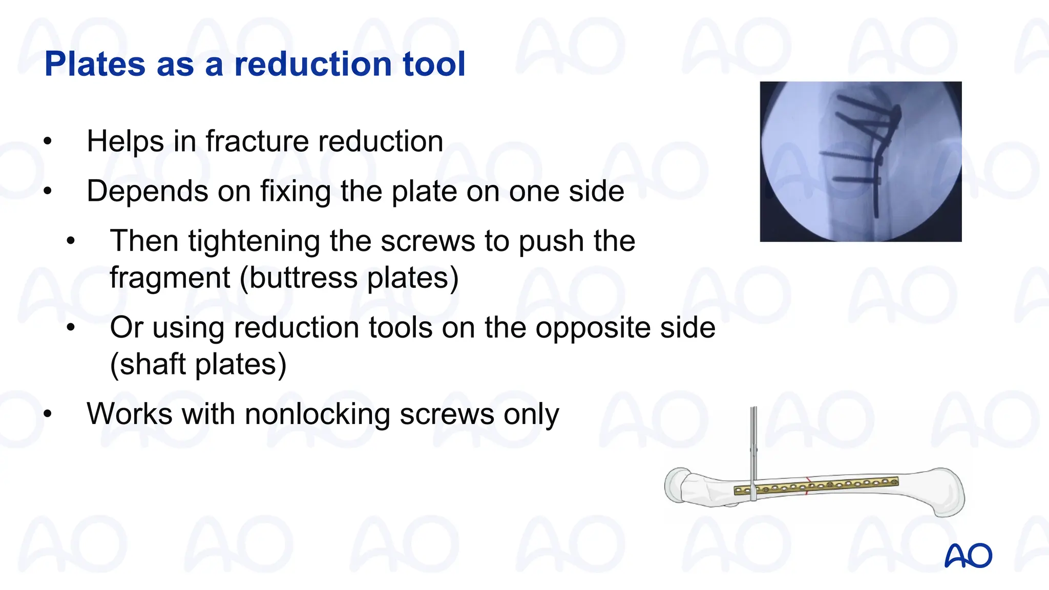 plates in fracture fixation on orthopedic | PDF