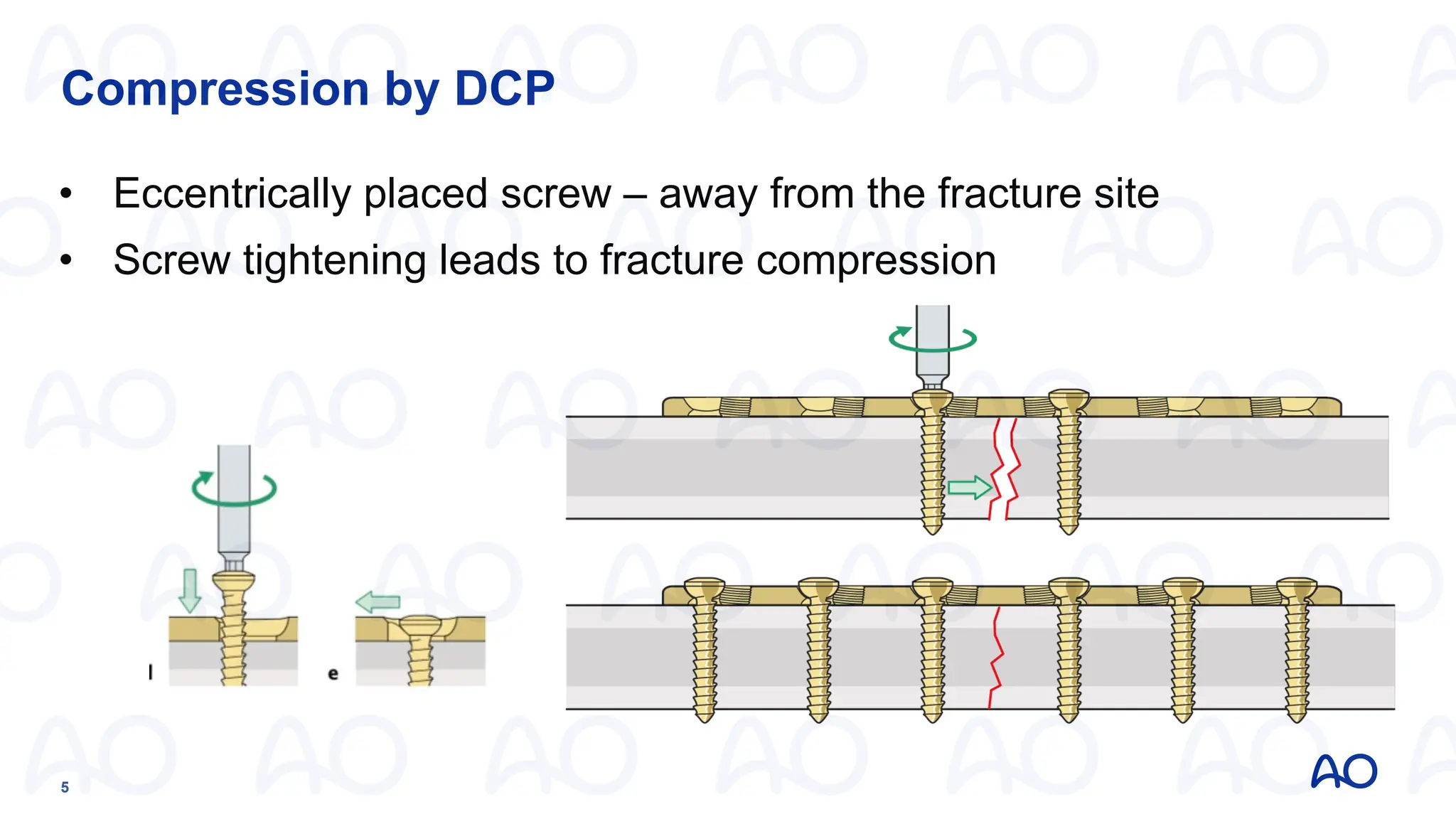 plates in fracture fixation on orthopedic | PDF