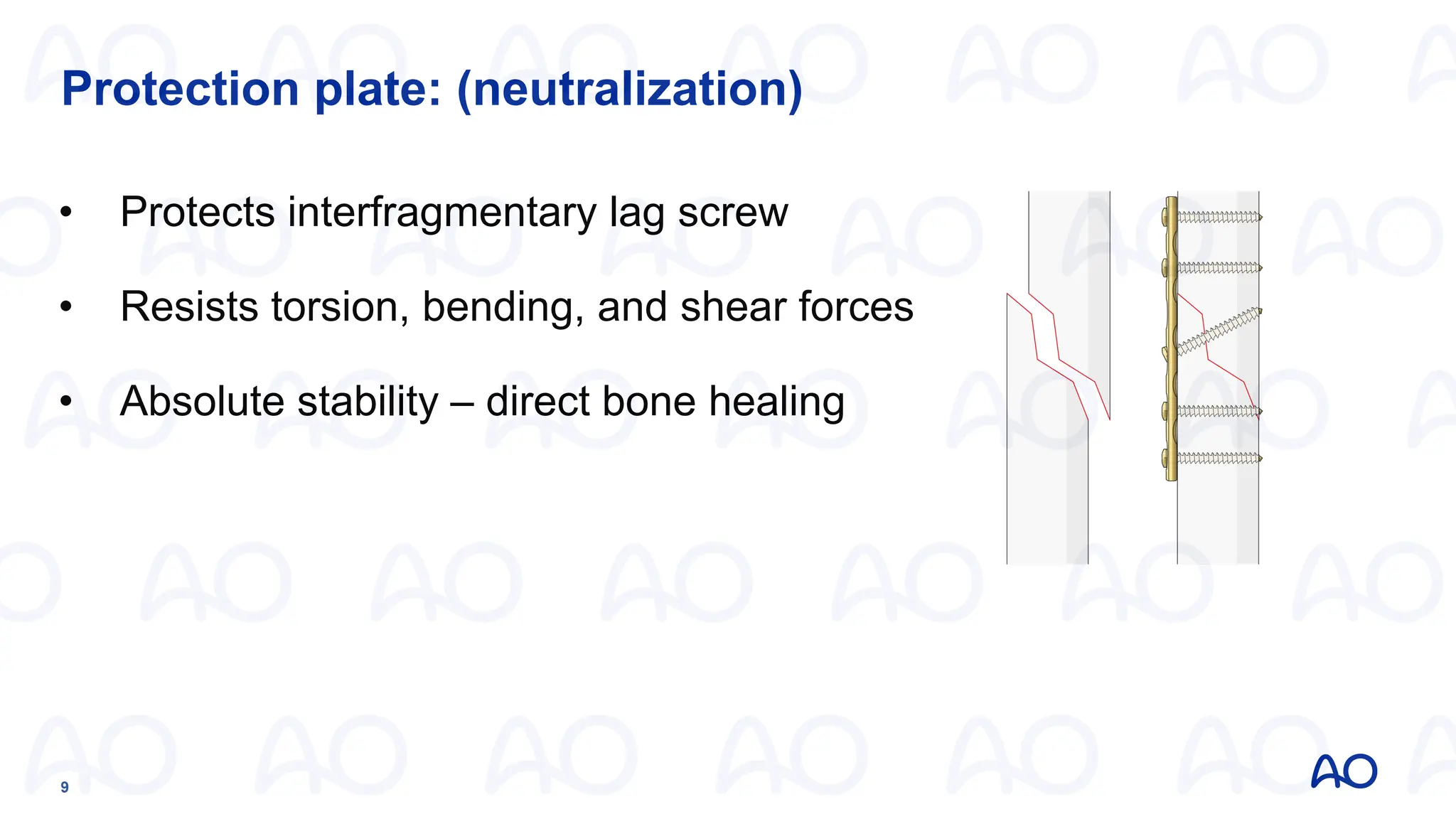 plates in fracture fixation on orthopedic | PDF