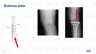 plates in fracture fixation on orthopedic | PDF
